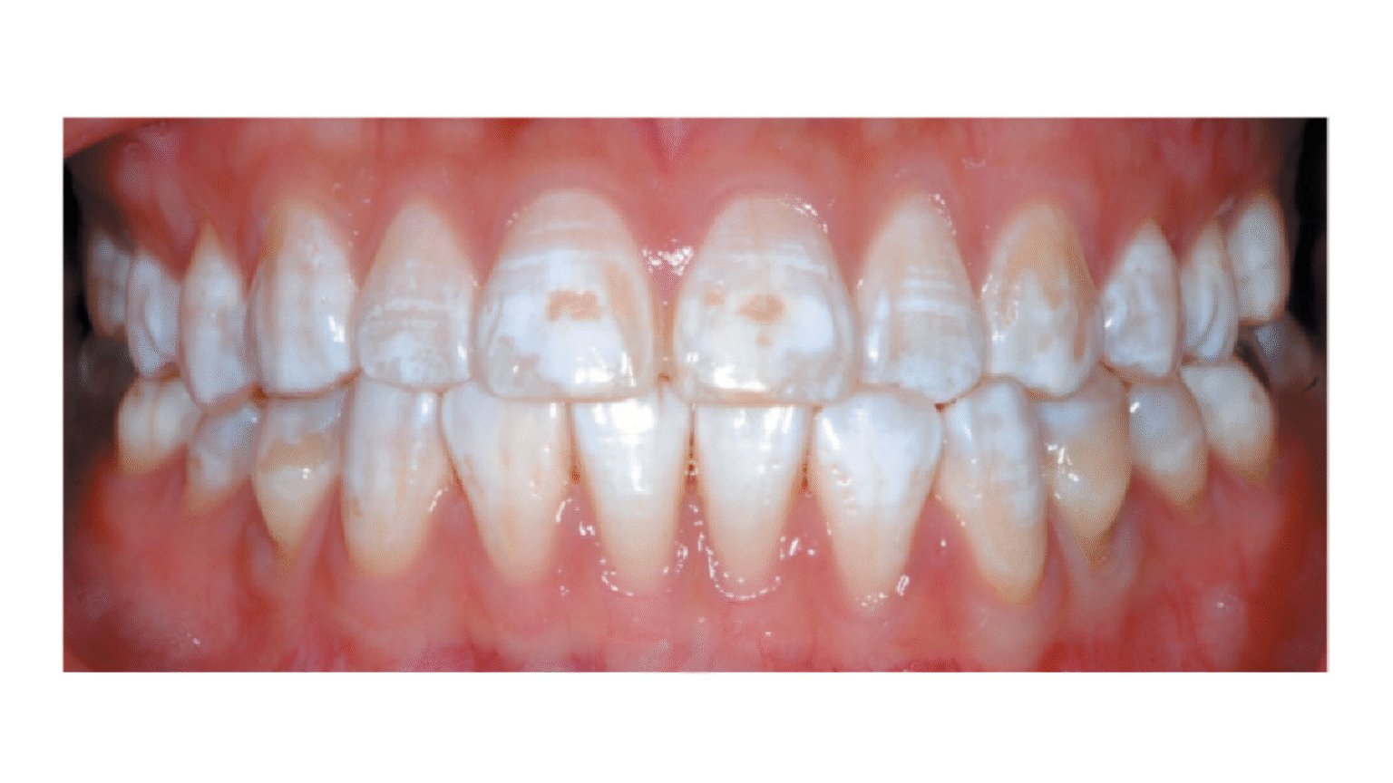 Fluorose Dentária: Guia Definitivo para não cair em mentiras